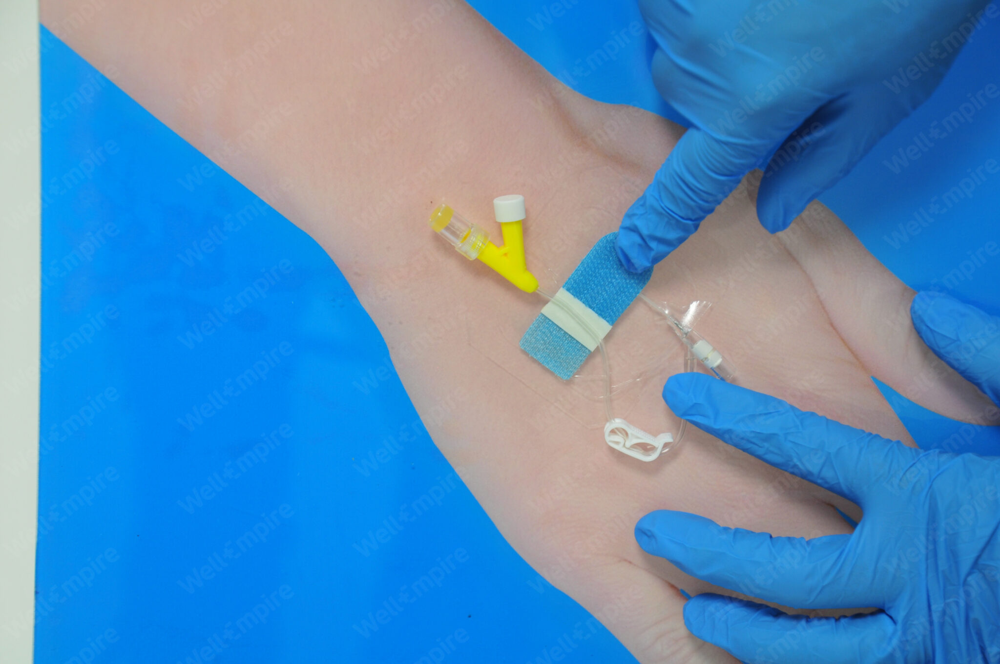 A4-1 Indwelling Needle, Peripheral IV Enhanced Acrylic Glue Catheter ...